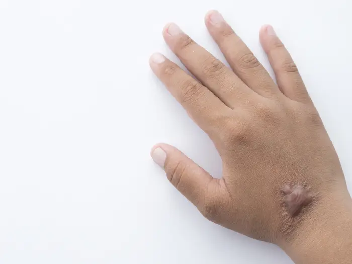 Keloids Hypertrophic Scars