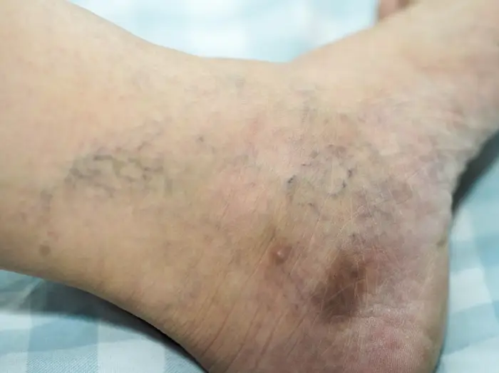 Spider angioma is an asymptomatic blanchable pink papule found on the ...
